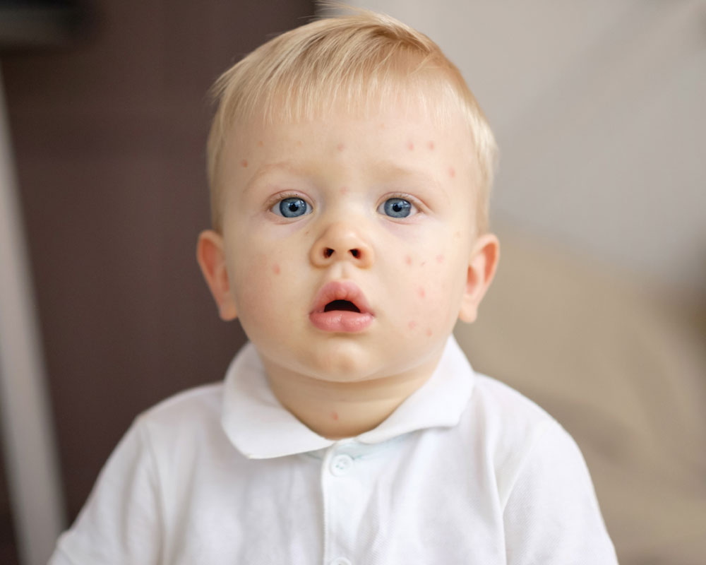 Sintomas do sarampo nos bebés · Moltex Baby